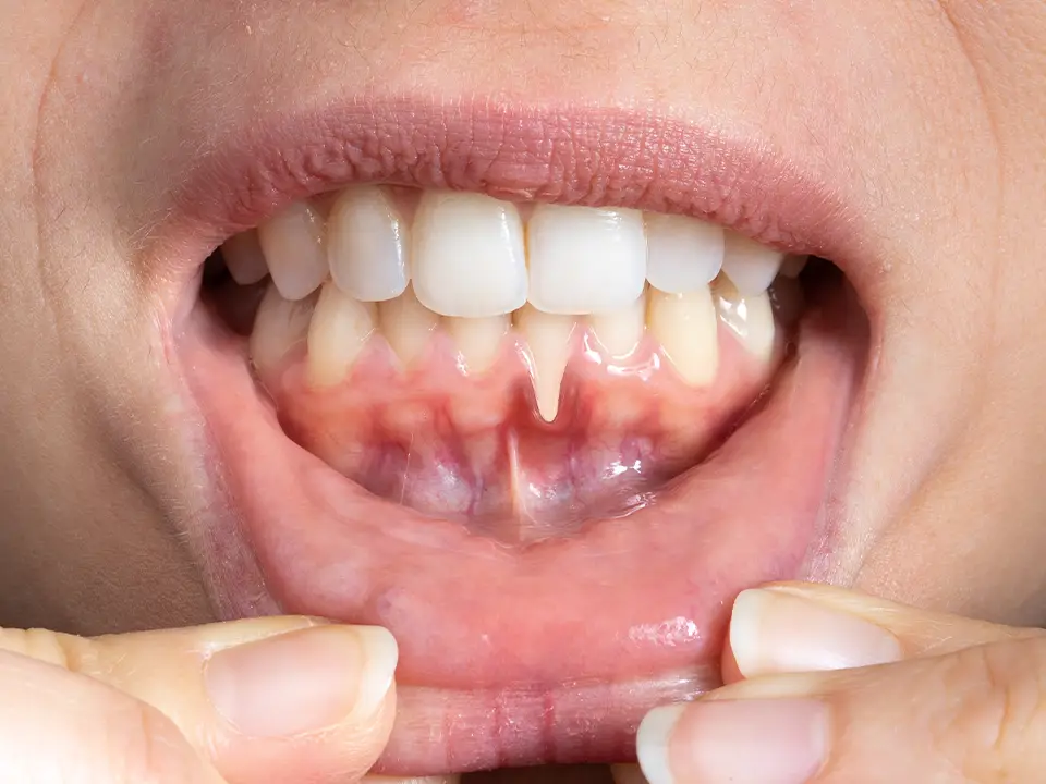 The Ultimate Guide to Maintaining Healthy Gums –Tips from Dental Experts